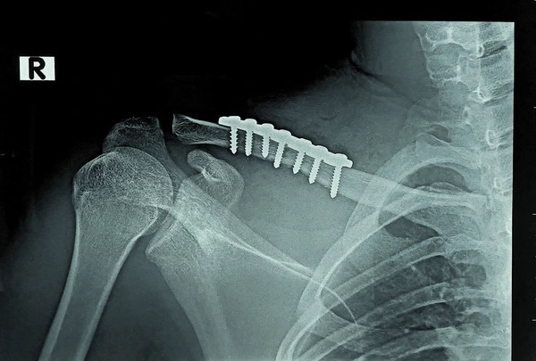 Cascadia MTB: The Art of Recovery: Healing Right After a Mountain Bike Injury – BMX Oregon